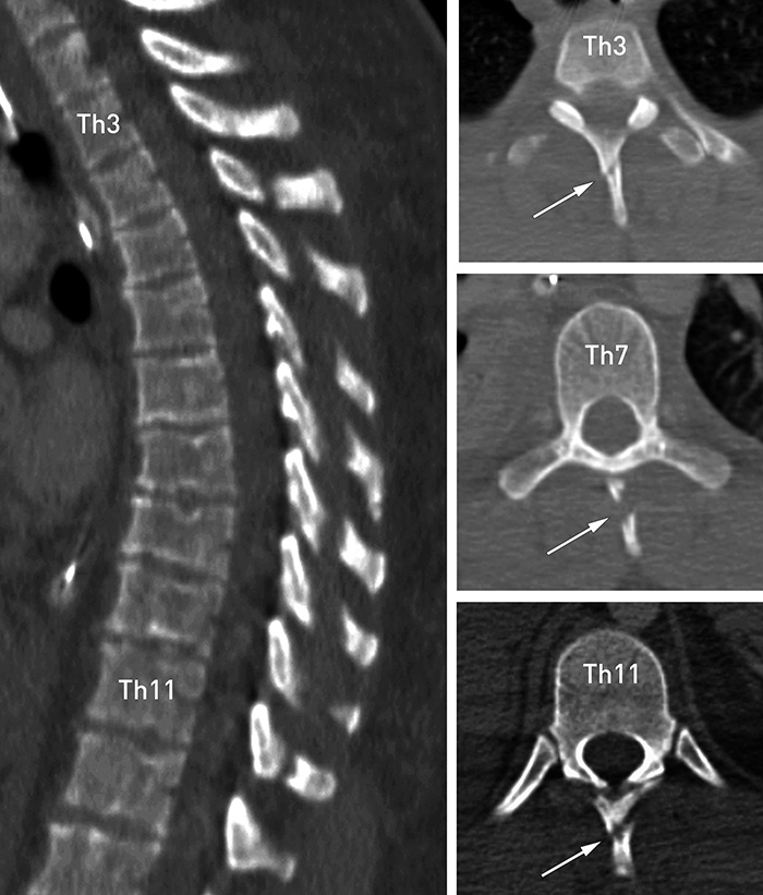 Clay-shoveller’s fracture | Tidsskrift for Den norske legeforening