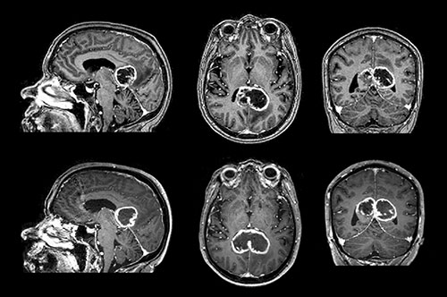 Butterfly glioma | Tidsskrift for Den norske legeforening
