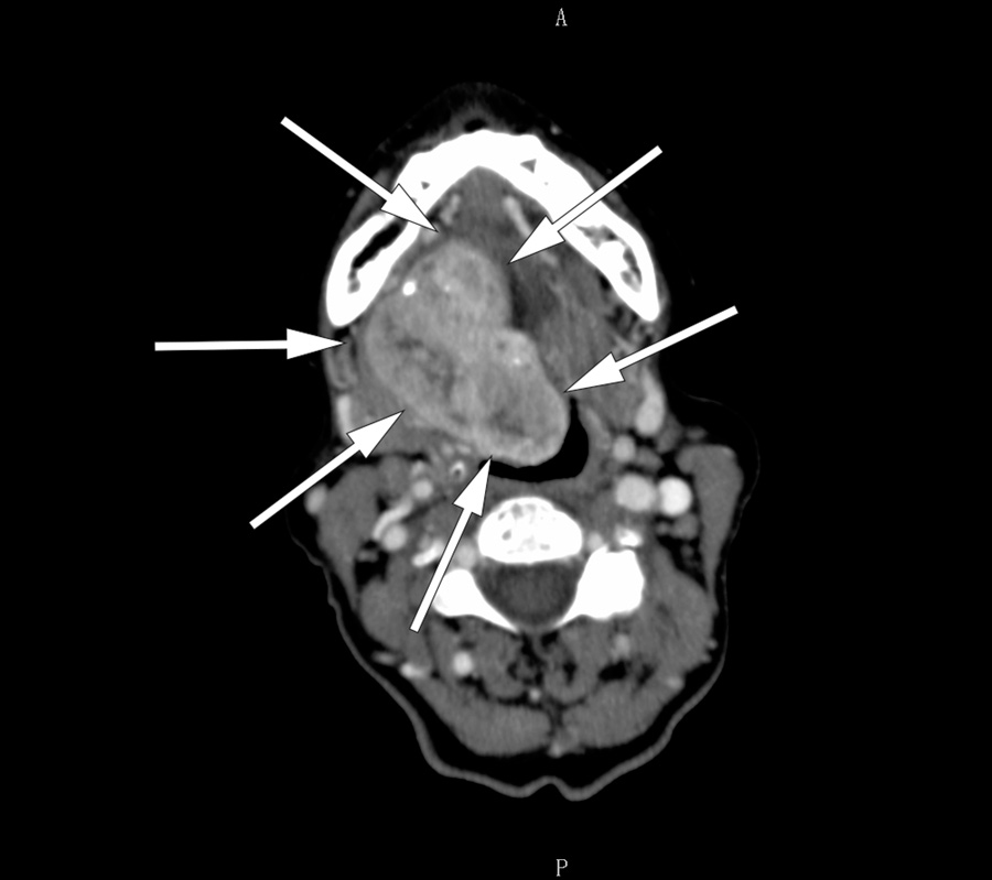 Ectopic Thyroid Tidsskrift For Den Norske Legeforening