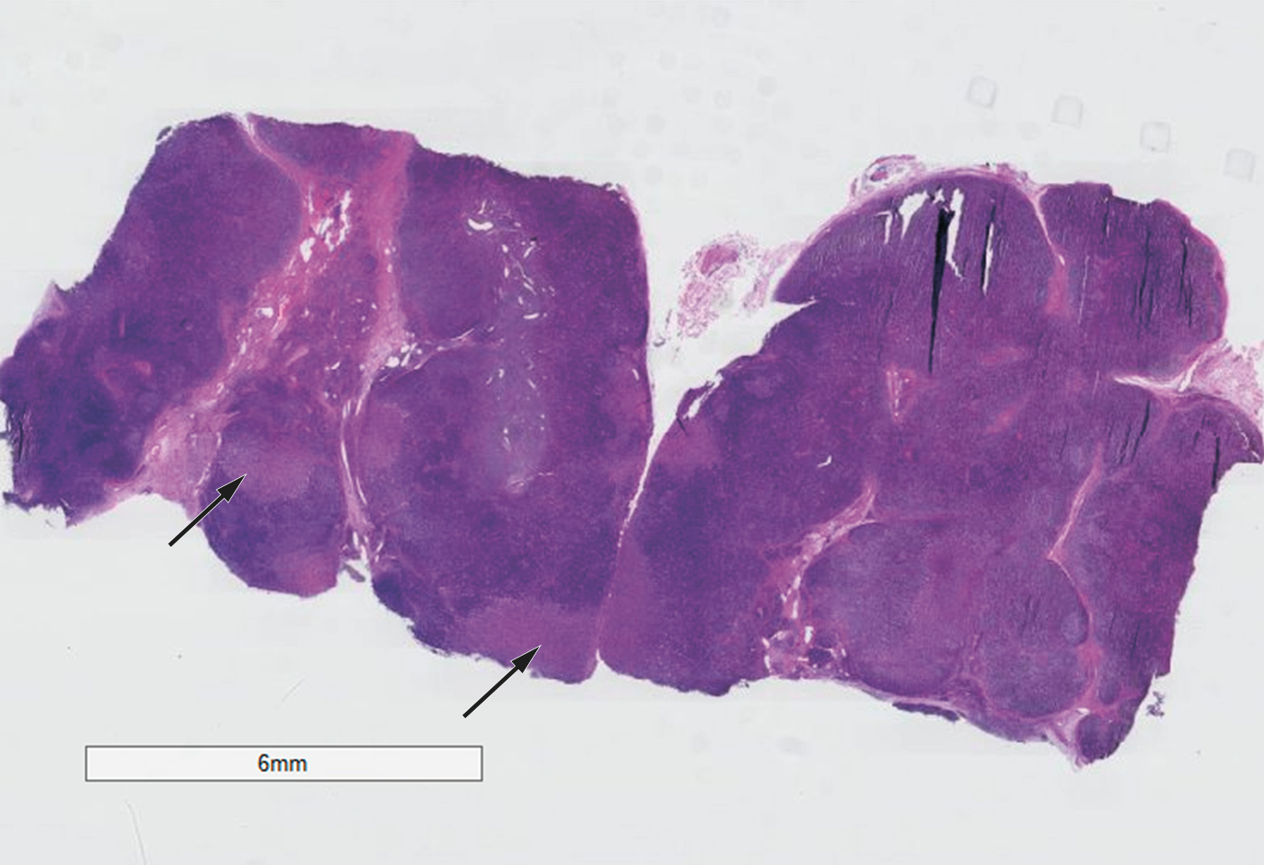 Kikuchi's disease | Tidsskrift for Den norske legeforening