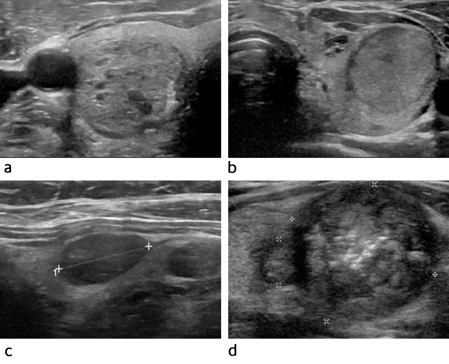 Thyroid Nodules Investigation And Follow up Tidsskrift For Den