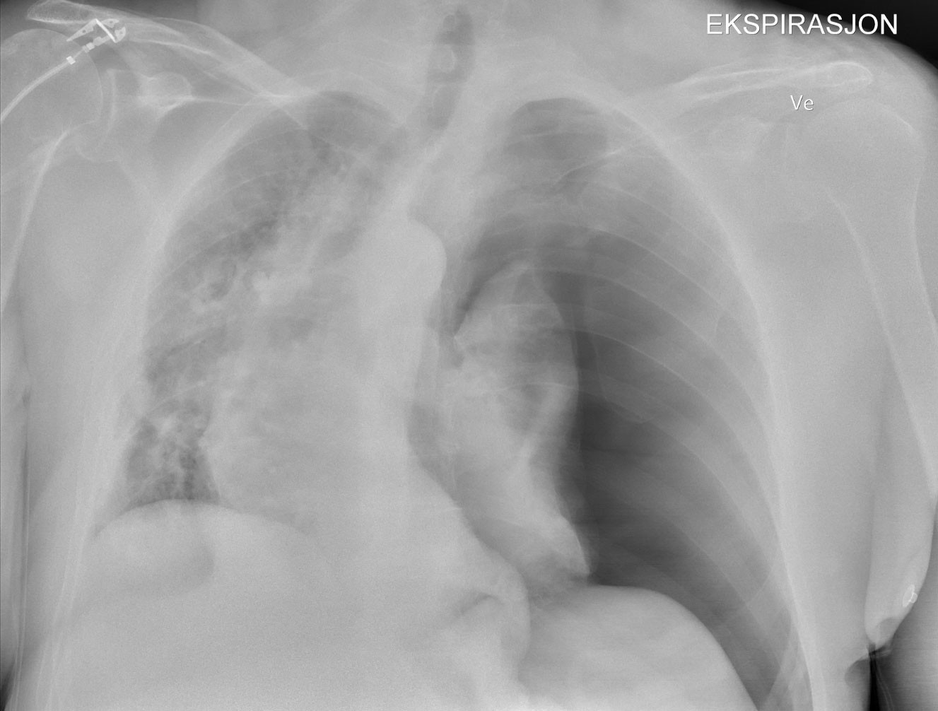 Pneumothorax during shoulder surgery | Tidsskrift for Den norske ...