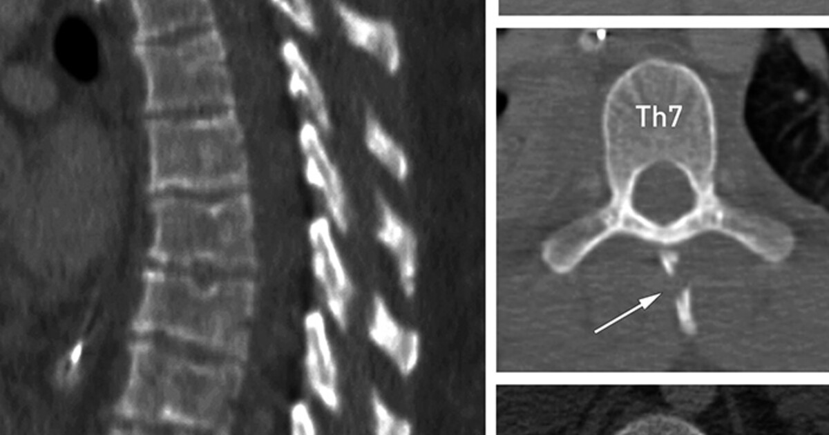 Clay-shoveller’s fracture | Tidsskrift for Den norske legeforening