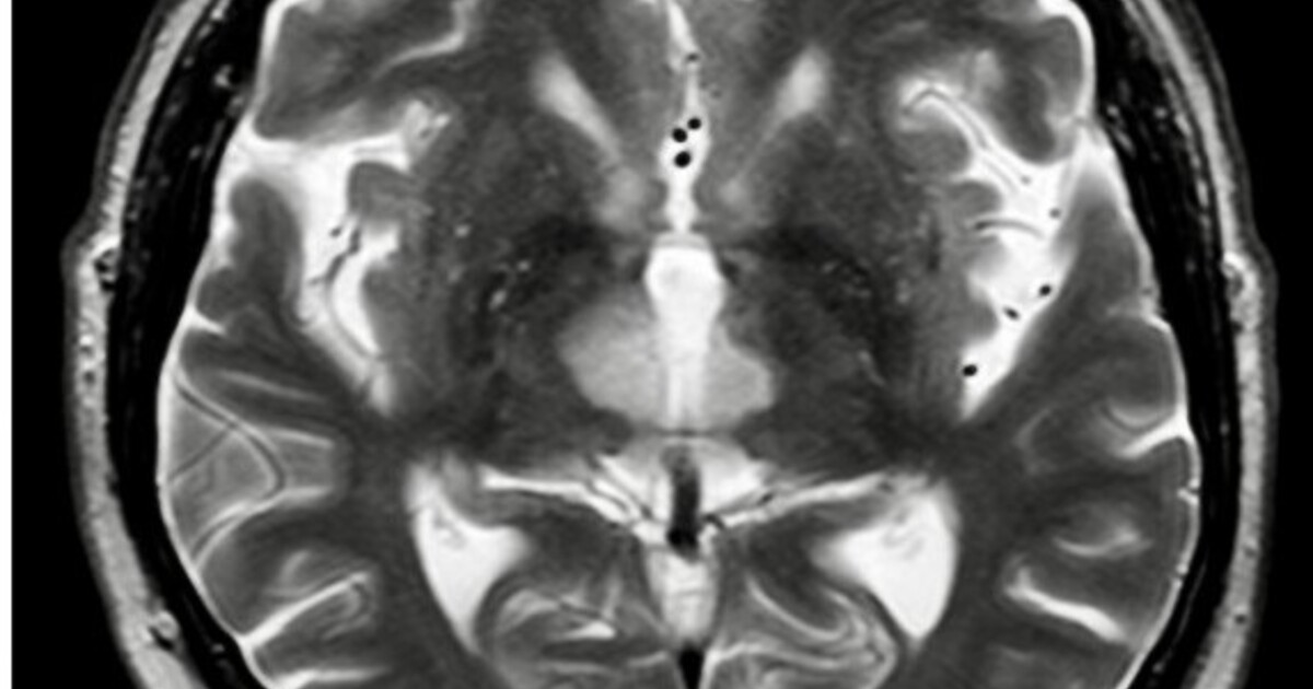 Artery of Percheron occlusion | Tidsskrift for Den norske legeforening