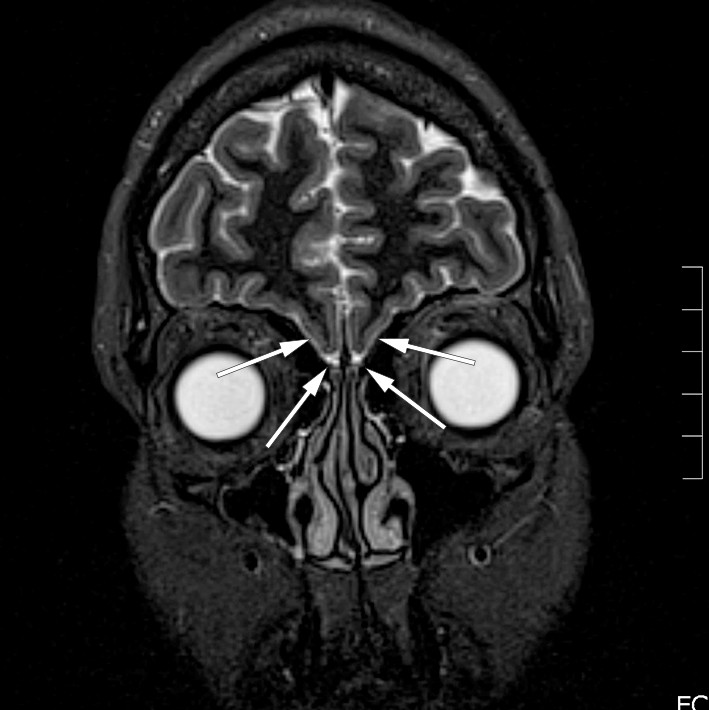Kallmann syndrome | Tidsskrift for Den norske legeforening